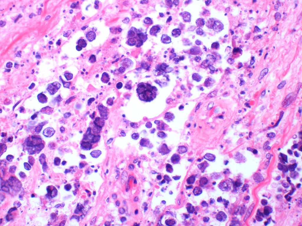 herpes_simplex_virus - HPV Online - Tudo o que você precisa saber sobre ...